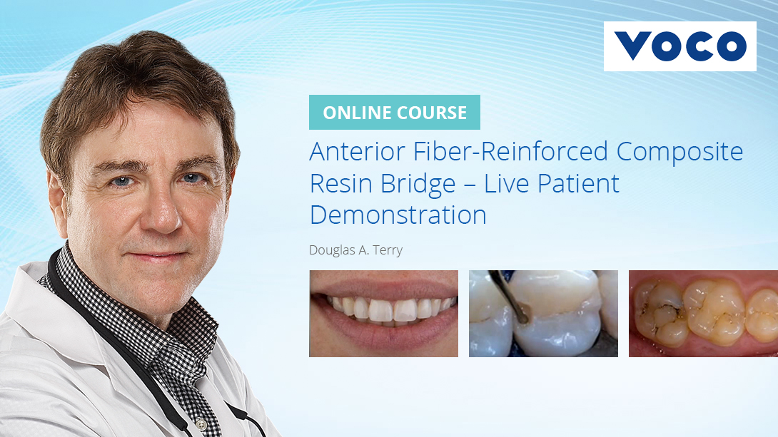 Dt Study Club Webinar Anterior Fiber Reinforced Composite Resin Bridge