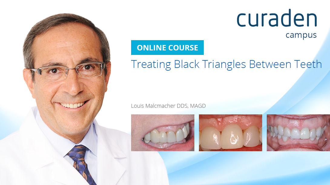 DT Study Club Webinar: Treating Black Triangles Between Teeth