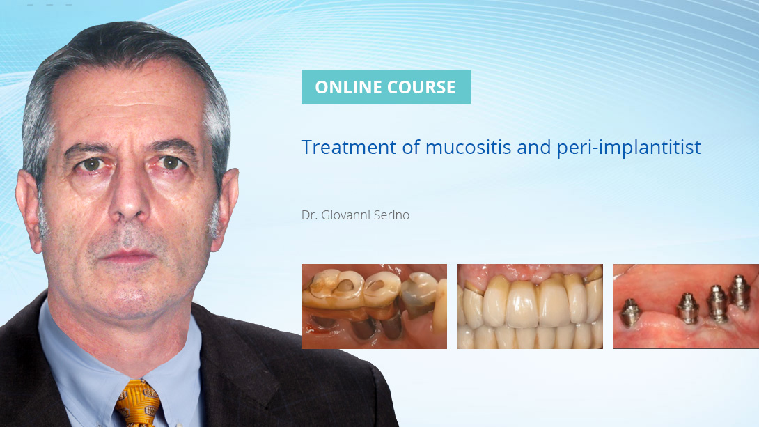 DT Study Club Webinar: Treatment of mucositis and peri-implantitis
